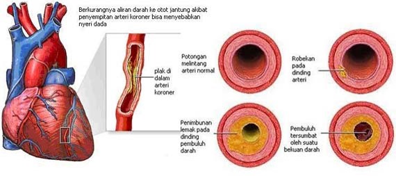 SAYANGI JANTUNG KITA: STREPTOKINASE BISA MENGHANCURKAN GUMPALAN LEMAK ...