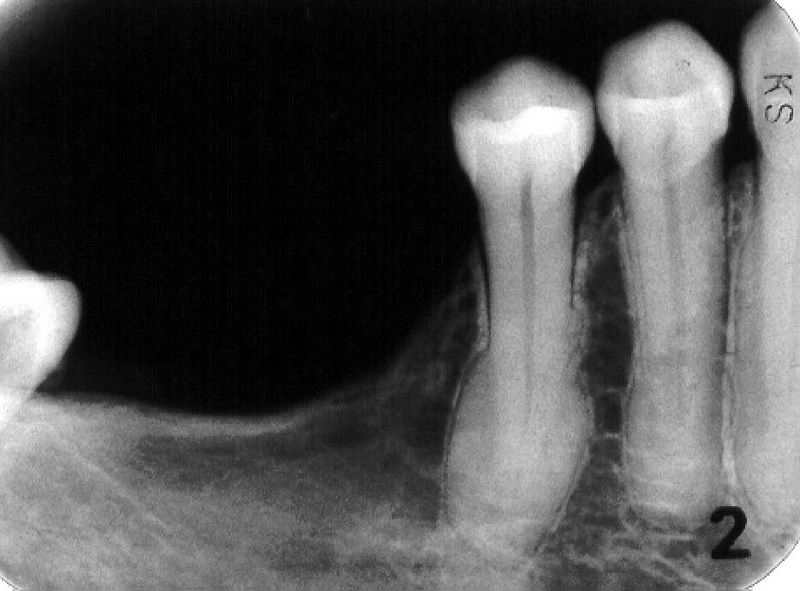 Odonto na Facul: Caso Clínico #1: Hipercementose