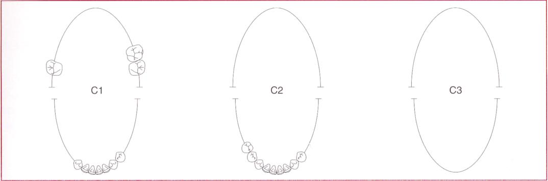 インプラント・審美歯科は練馬 区の歯医者さんマイスター春日歯科クリニックにおまかせ！: アイヒナーの分類C Eichner's ...