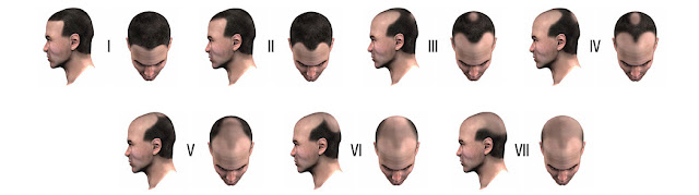 No visible signs of receding or thinning.