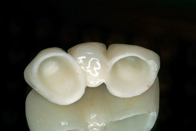 The Dental Tourist: 34: PFM=NO, PFZ=NO, PZ=Si!