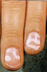 ARTE, TERAPIAS & QUIROLOGIA : QUIROLOGIA - MANCHAS BRANCAS NAS UNHAS