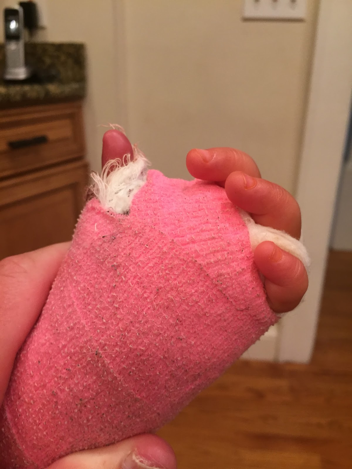 Pollicization- concerns immediately after surgery | Congenital Hand and ...