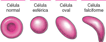 Punto Yake, Estancia del Yaque-Navarrete: Signos y síntomas de la Falcemia