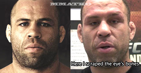 Wanderlei Silva Plastic Surgery Before and After Photos - Star Plastic ...