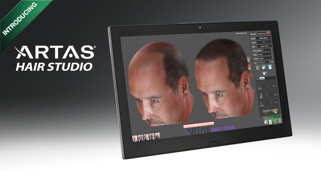 Tampa Bay Hair Restoration Solutions : ARTAS-Robotic Hair Transplant