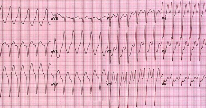 Cardiac Arrest. Shockable and Non-Shockable Rhythms.