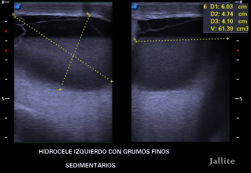 Hidrocele Bilateral & Hipotrofia Testicular
