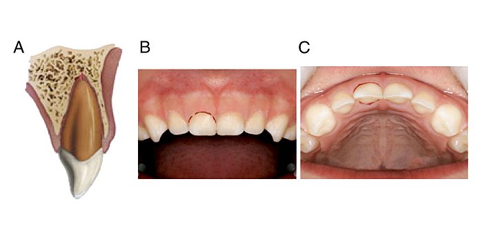 Dental trauma in children: What can we do? - OdontoVida