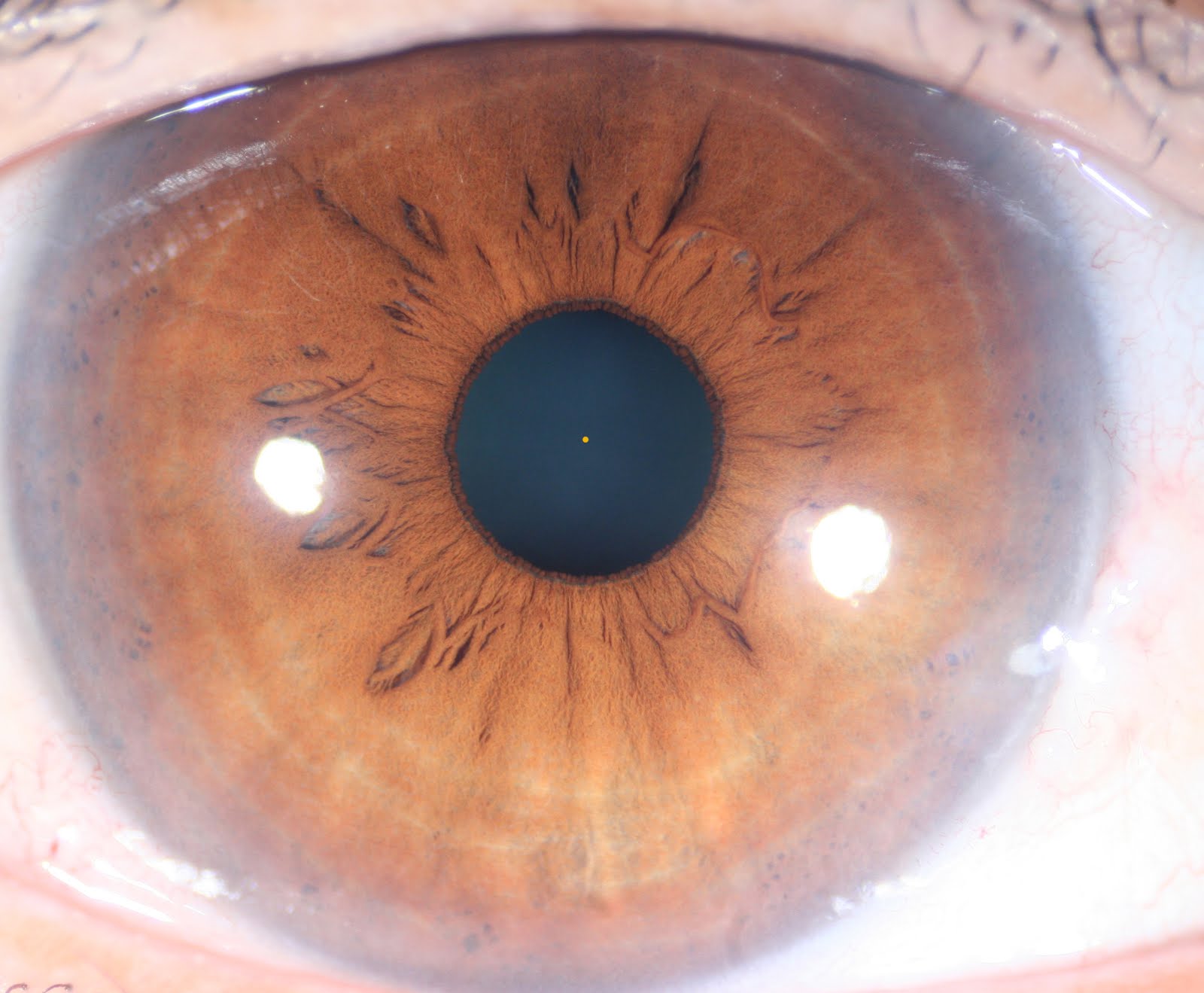 Modern & Multidimensional Iridology: Frontal Pupil Flattening, HPA Axis ...