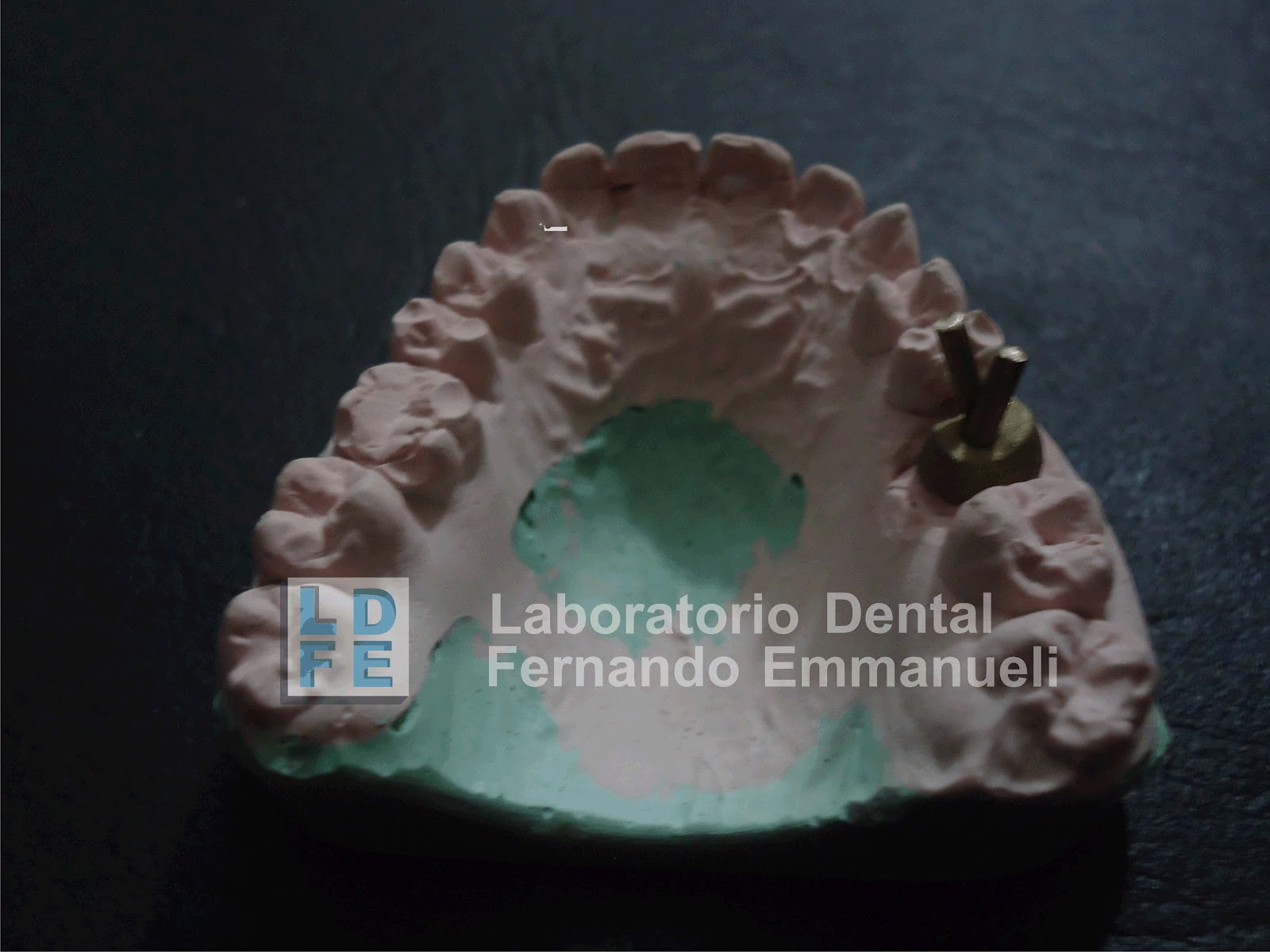 Laboratorio Dental Fernando Emmanueli: Pernos