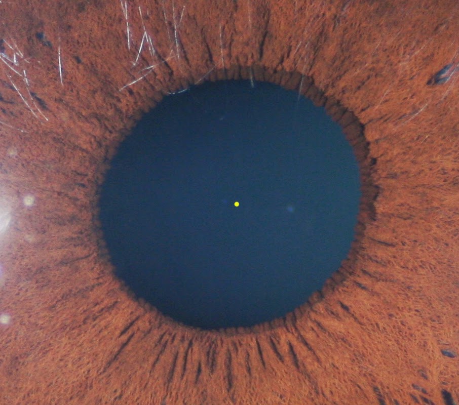 Modern & Multidimensional Iridology: Mixed Inner Pupillary Border ...