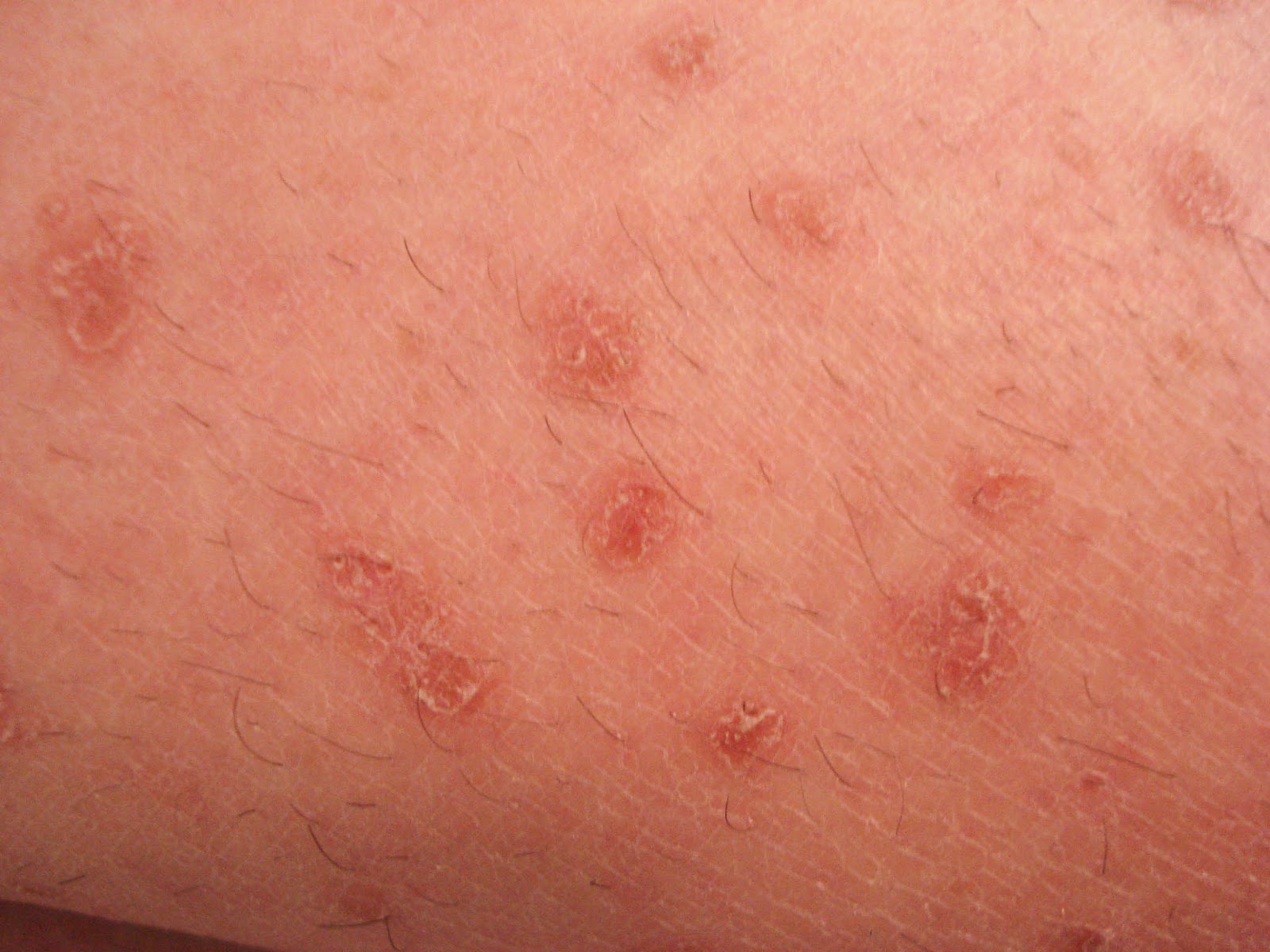 VIRTUAL GRAND ROUNDS IN DERMATOLOGY 2.0: Primary Biliary Cholangitis ...