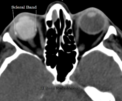 El Baúl Radiológico: BANDA ESCLERAL DE SILICONA: HALLAZGOS EN ...