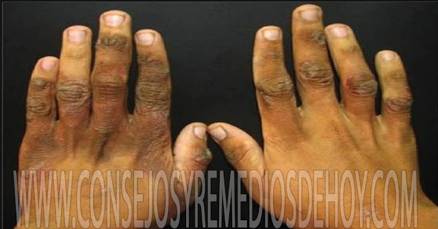 Como Eliminar Las Manchas En Manos, Codos Y Rodillas - Consejos y remedios