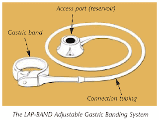 British Surgical Clinic: Adjustable Gastric Banding - Information for ...