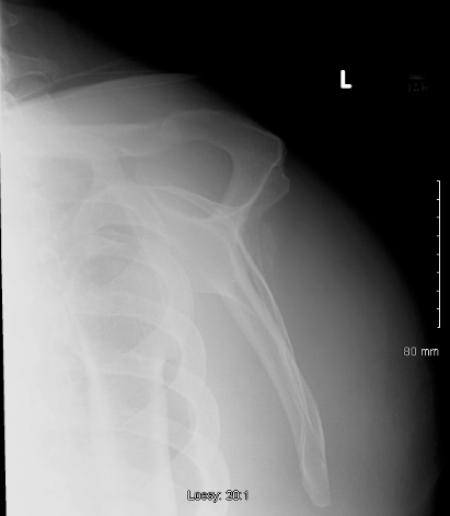 Shoulder and Elbow Surgery: Shoulder dislocation resulting in massive ...