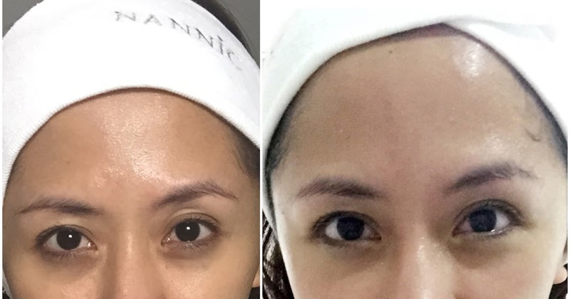Wiped years off your face with Nannic NBE Radio Frequency Treatment ...
