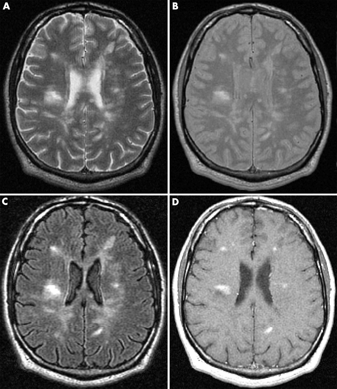 Brain Lesions: Brain Lesions Ms Or Stroke