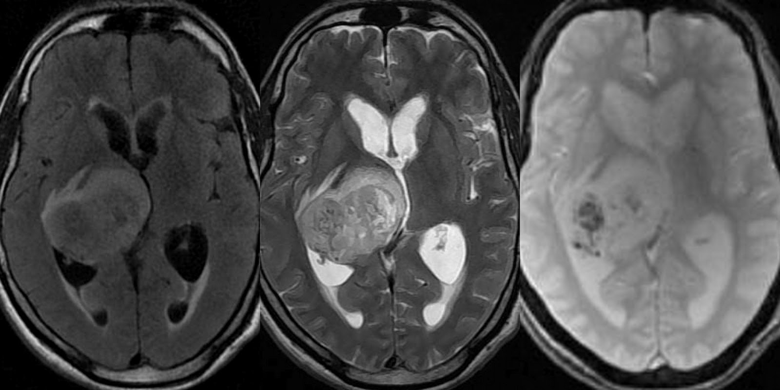 Glioma Glioma Anaplastic Astrocytoma Brain Tumor
