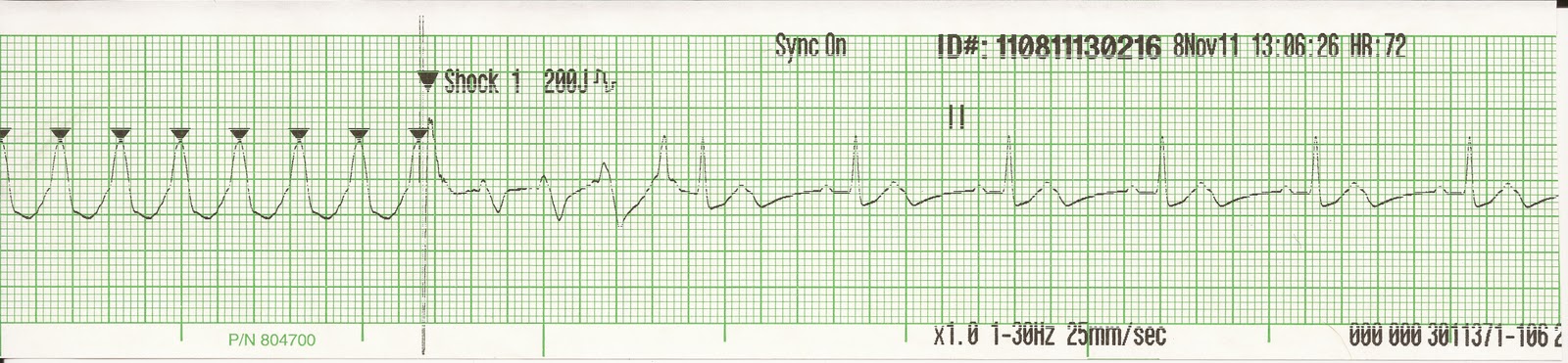 ACLS review: Wide Complex Tachycardia (WCT) Part 7