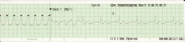 ACLS review: Wide Complex Tachycardia (WCT) Part 7