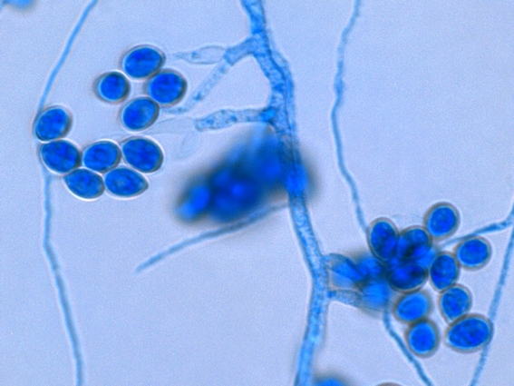 Fun With Microbiology (What's Buggin' You?): Scedosporium prolificans