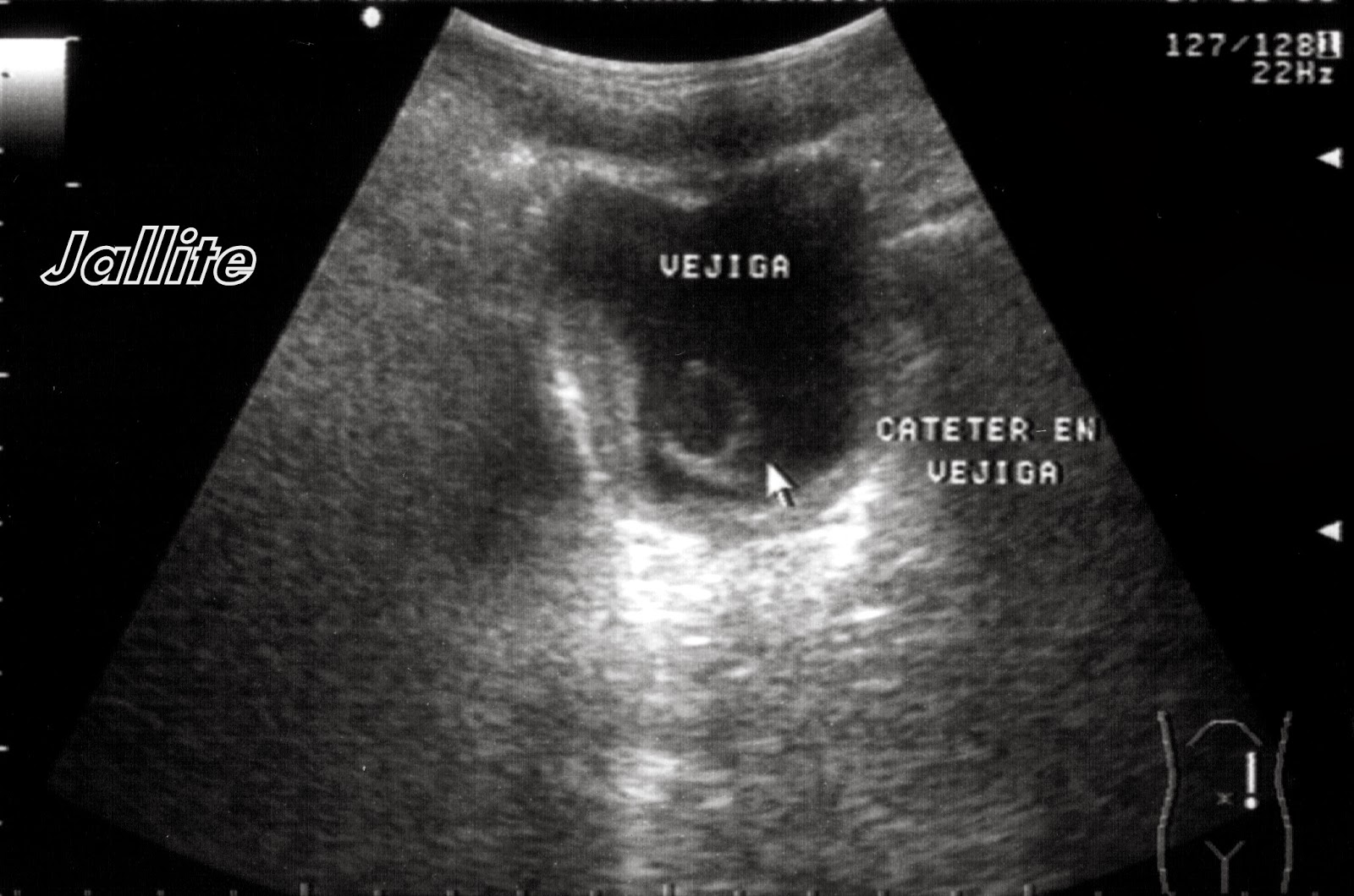 Catéter Vesico-Renal