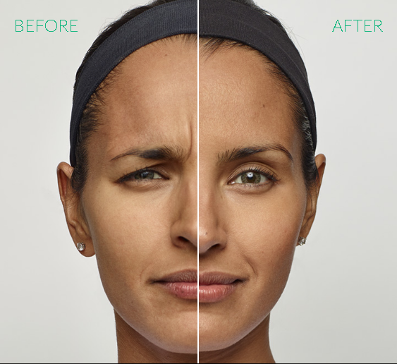 Toxina Botulínica y las lineas de expresión