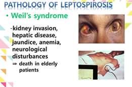 Health syndrome weils - www.24wikiss.blogspot.com