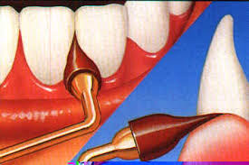 8 Alat Bantu Untuk Membersihkan Gigi