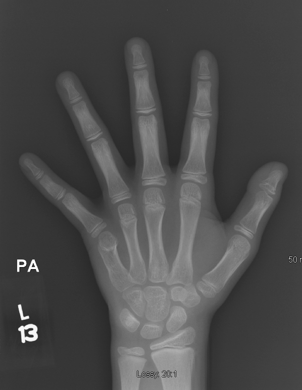 Short Fingers- Brachydactyly | Congenital Hand and Arm Differences ...