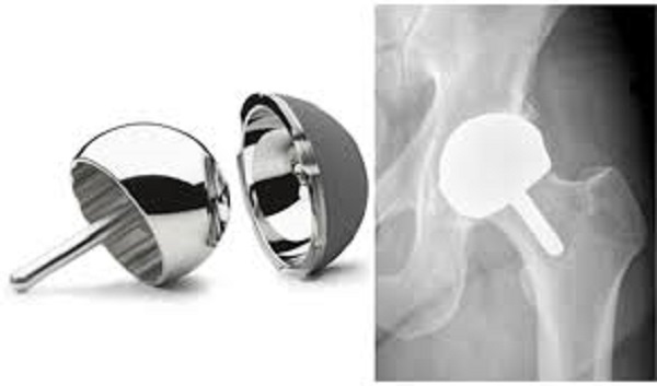 Why to Choose Affordable Hip resurfacing Surgery Hospital India - Quick ...