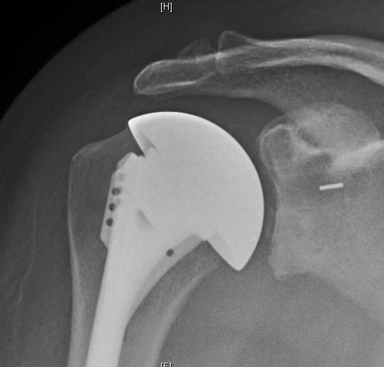 UW Shoulder and Elbow Academy: Two sides of total shoulders, one with ...