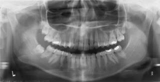 Dentistry lectures for MFDS/MJDF/NBDE/ORE: August 2011