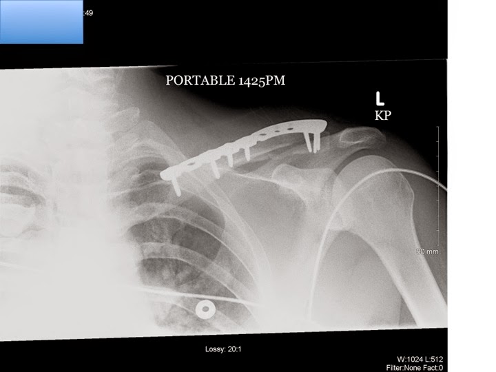 Shoulder and Elbow Surgery: Distal clavicle fracture fixation using ...