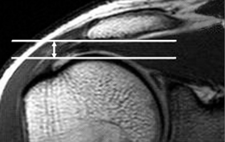 UW Shoulder and Elbow Academy: "Subacromial space" - what does it mean?