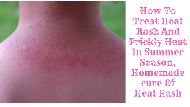 How To Treat Heat Rash And Prickly Heat In Summer Season, Homemade cure ...
