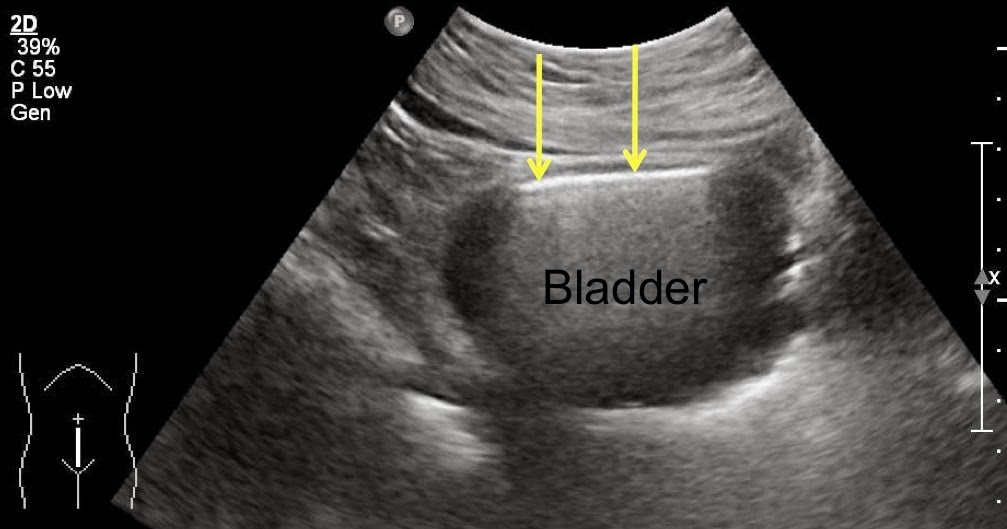 RiT radiology: Emphysematous Cystitis