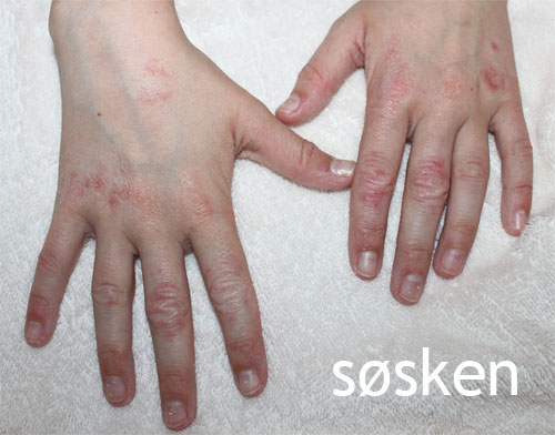 SØSKEN: 10 år med eksem -- vil storesøster noengang vokse det av seg