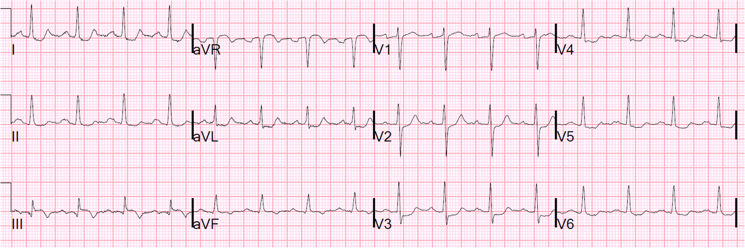 Dr. Smith's ECG Blog: A Non STEMI that needs the cath lab now.