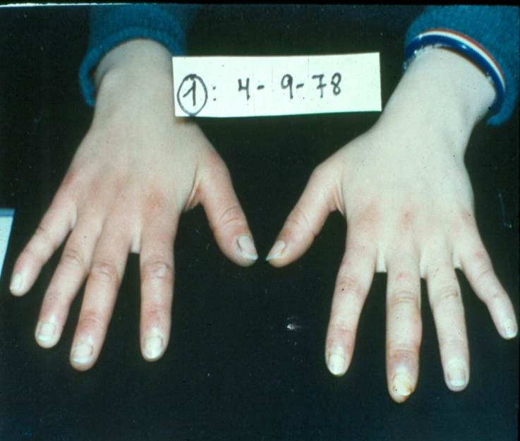 HOMEOPATÍA FICH: ACROCIANOSIS O SINDROME DE RAYNAUD CON GANGRENA DR ...