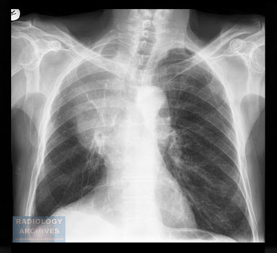 Radiology Archives: Golden* S Sign (Πυλαία Μάζα & Ατελεκτασία ΔΑΛ)