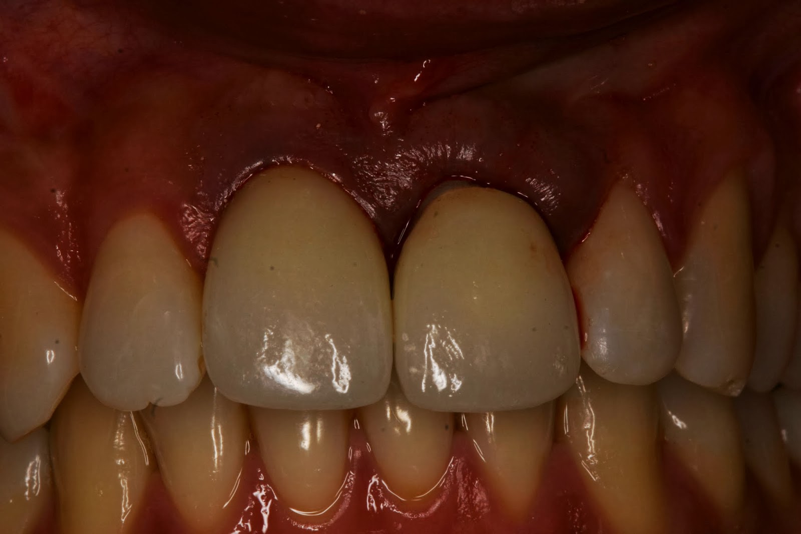 Dr. Robert G. Tupac: Prosthodontics: Immediate Single Tooth Implant