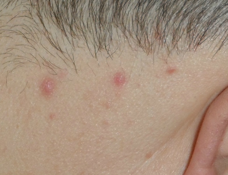 La Creatività di Anna!!!: TANDA ZAP, ELIMINA IL BRUFOLO IN UNO ZAP!