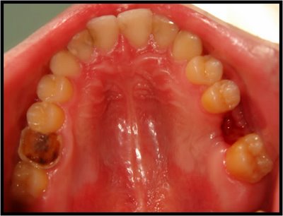 TRATAMIENTOS DENTALES: Mucosa y Tejido óseo en pacientes para Implantes ...