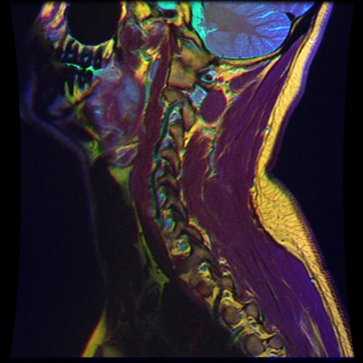Nevit's blog: Color MRI of Cervical vertebrae
