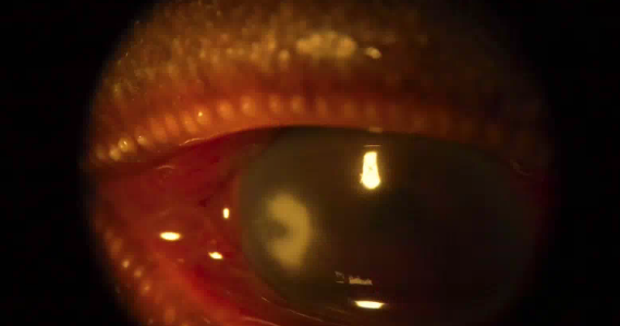 Cornea and Anterior Segment Imaging: Abscess and Ulcer Depth