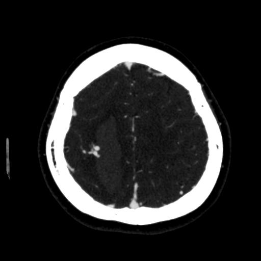 Post Gad: Small AVM with Large ICH