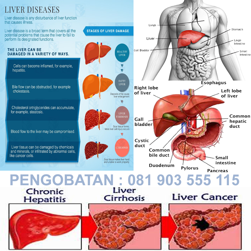 Obat Liver di Apotik: Beberapa penyebab utama seseorang terserang ...